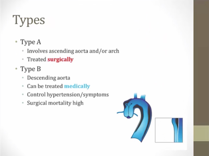 Aortic Dissection Wikipedia